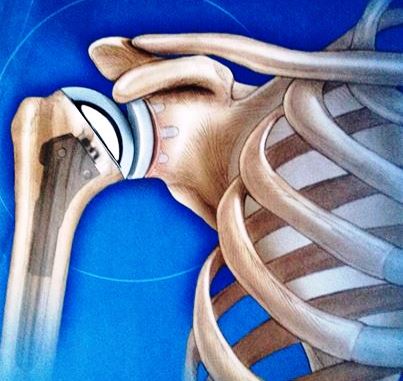 Shoulder Surgery and Replacement